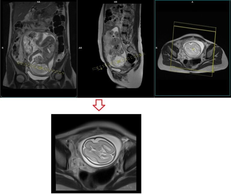 Fetal Brain MRI | Fetal Brain Scan Protocol and Planning
