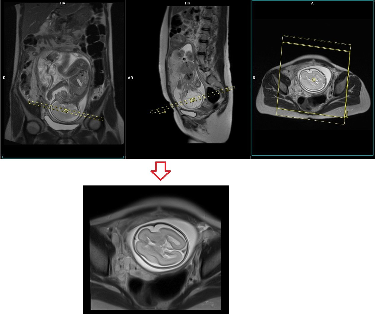 Fetal Brain MRI | Fetal Brain Scan Protocol and Planning