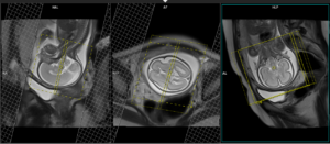 Fetal Brain MRI | Fetal Brain Scan Protocol and Planning