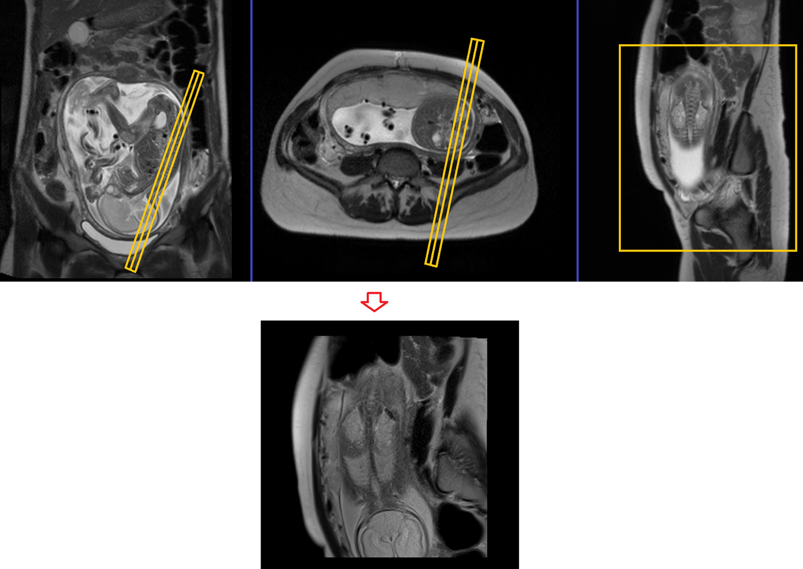 Fetal MRI Spine Scan protocol and planning