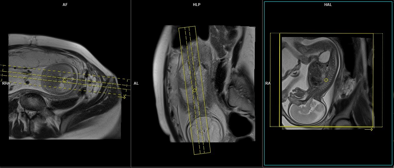 Fetal MRI Spine Scan protocol and planning
