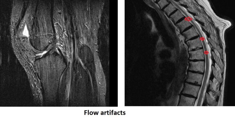 flow artifact mri | csf flow artifact