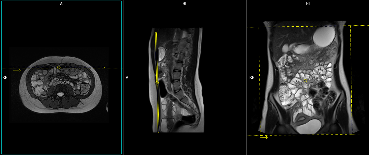 Small bowel MRI (Enterography) Planning and Protocols | MRI ...