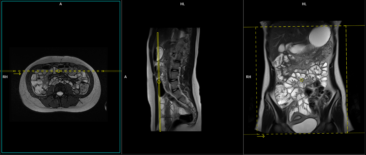 Small bowel MRI (Enterography) Planning and Protocols | MRI ...