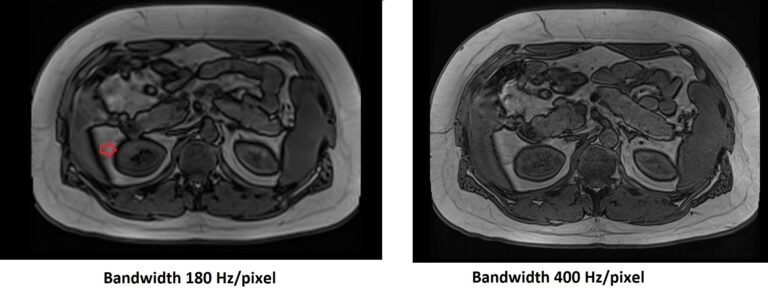 Chemical Shift Artifact MRI