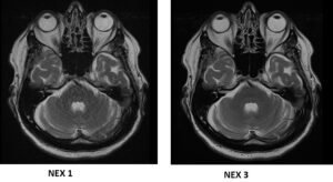 MRI Signal-to-noise ratio related artifact | SNR artifacts
