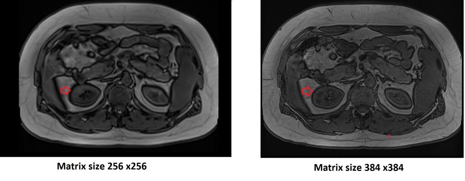 Chemical Shift Artifact MRI