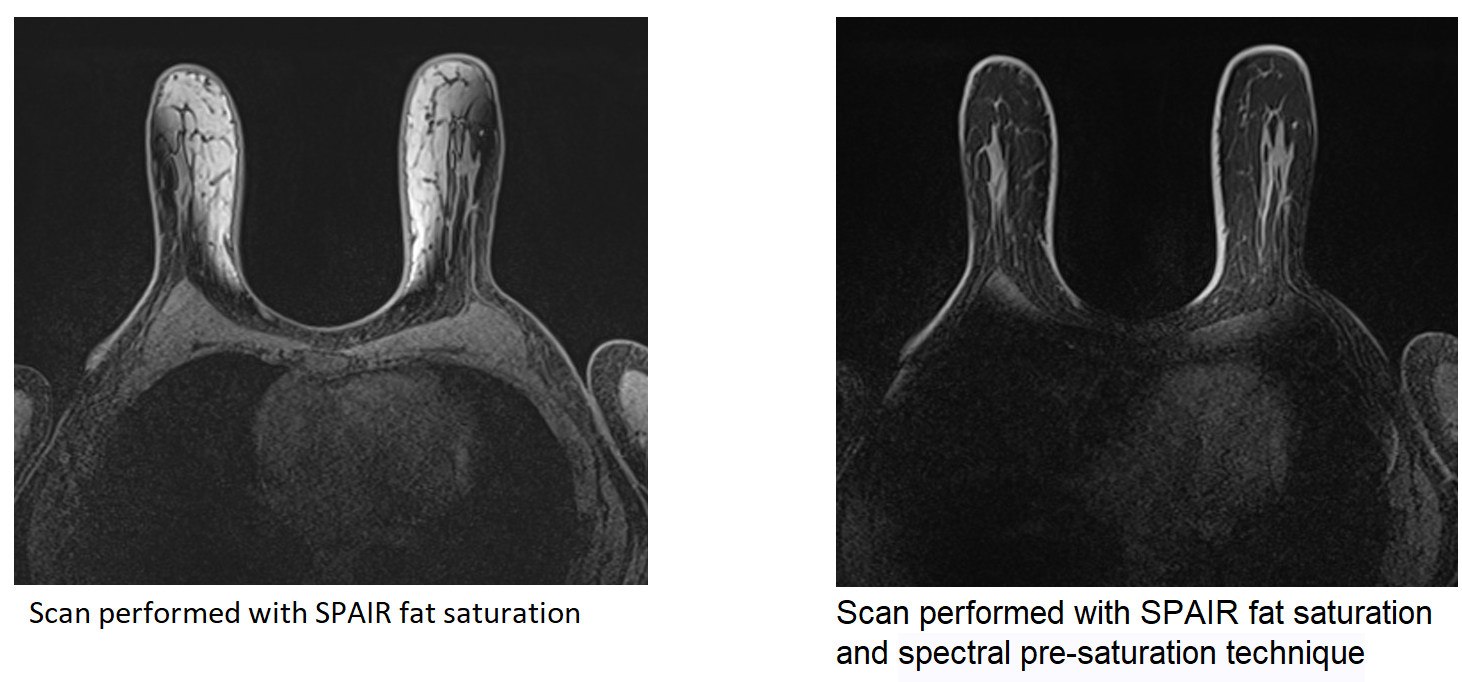 fat suppression artifact MRI | Lipid suppression artifact