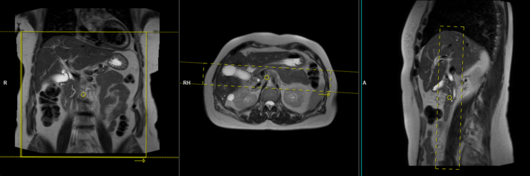 MRCP Planning |MRCP Protocols | Indications for MRI ...