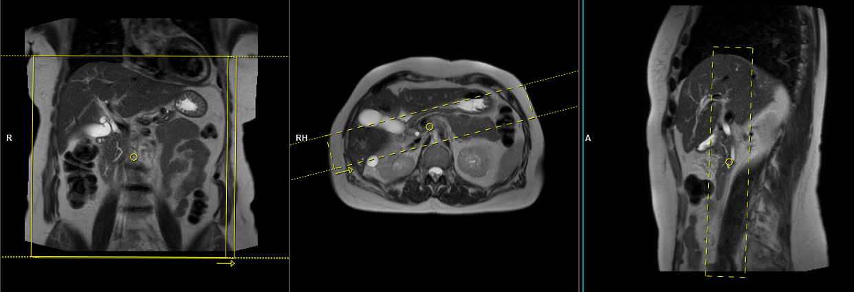 MRCP Planning |MRCP Protocols | Indications for MRI ...