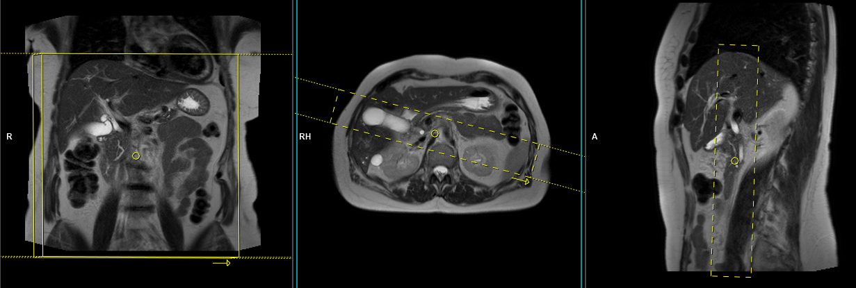 MRCP Planning |MRCP Protocols | Indications for MRI ...