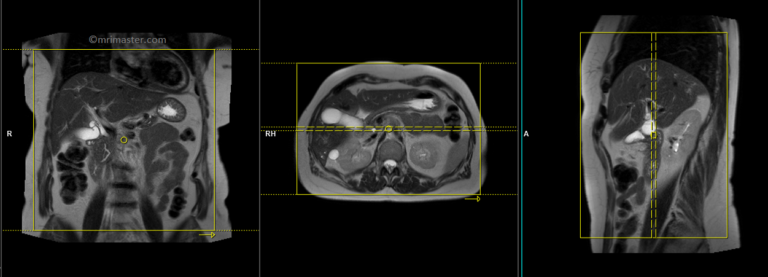 MRCP Planning |MRCP Protocols | Indications for MRI ...