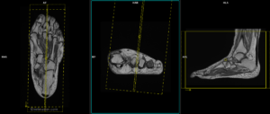 Foot MRI Protocols and Planning | Indications for MRI Foot Scan