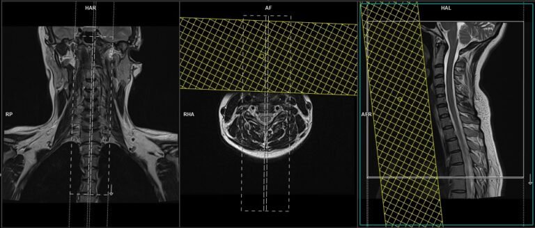 Cervical Spine MRI protocols and planning | indications for MRI ...