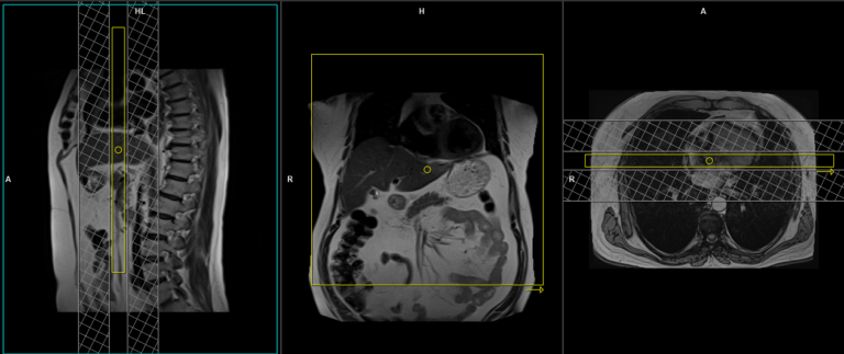 MRA and MRV Abdomen Planning and Protocols | Indications for MRA and ...