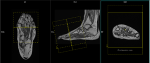 MRI forefoot | MRI forefoot protocol and planning