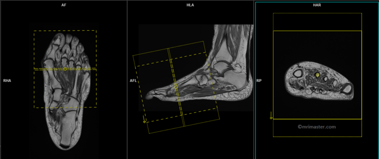 MRI forefoot | MRI forefoot protocol and planning