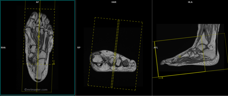MRI forefoot | MRI forefoot protocol and planning