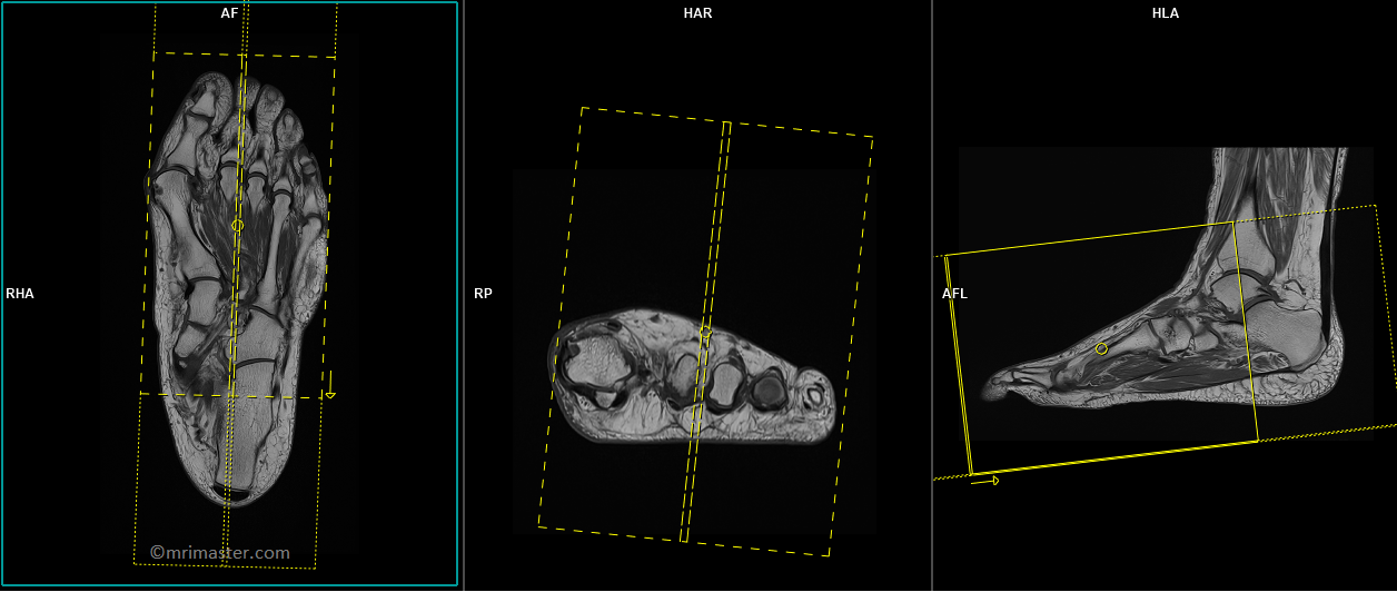 MRI forefoot | MRI forefoot protocol and planning