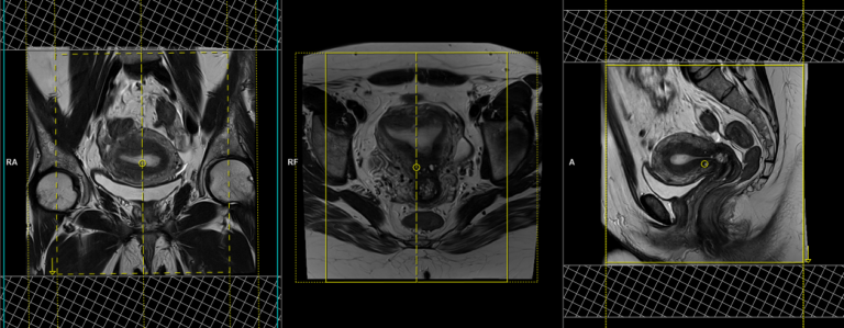 Gynaecologic MRI Pelvis (Uterus,Cervix and Adnexal) Protocols and ...