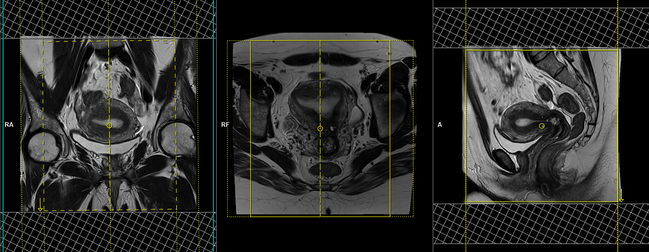 Gynaecologic MRI Pelvis (Uterus,Cervix and Adnexal) Protocols and ...