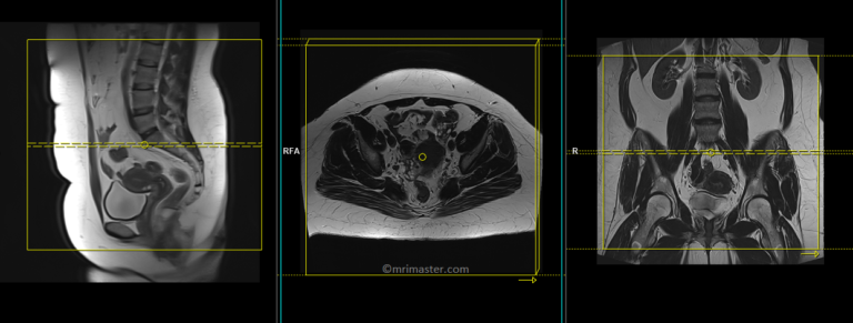 Gynaecologic MRI Pelvis (Uterus,Cervix and Adnexal) Protocols and ...