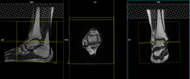 Ankle MRI Protocols and Planning | Indications for Ankle MRI Acan