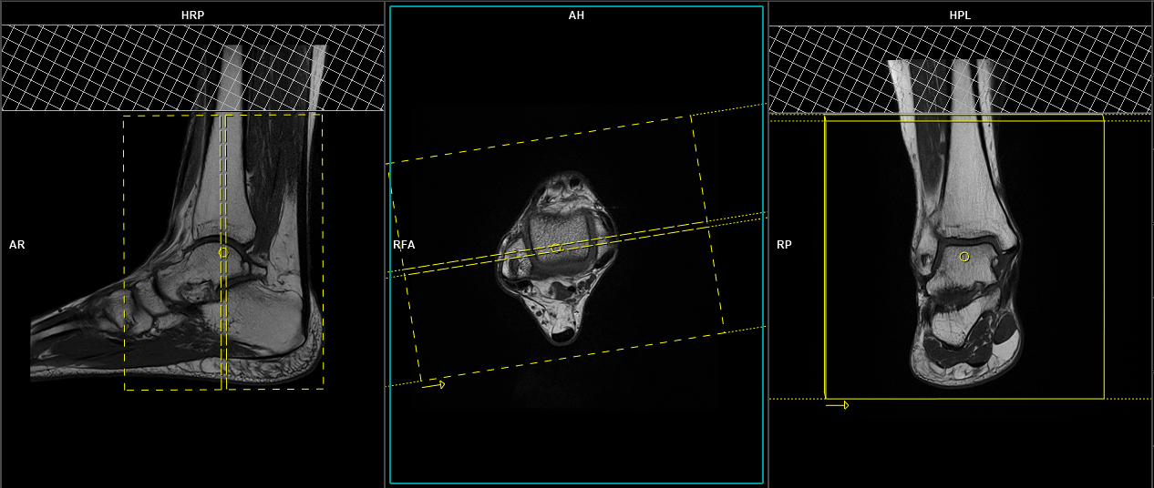Ankle MRI Protocols and Planning | Indications for Ankle MRI Acan