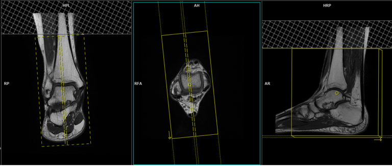 Peroneal tendon MRI protocol and planning