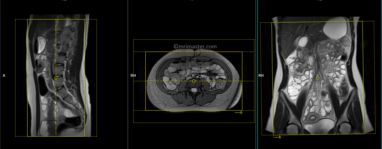 Small bowel MRI (Enterography) Planning and Protocols | MRI ...