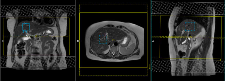 MRCP MRI |MRCP Free Breathing Protocols, Planning, Indications