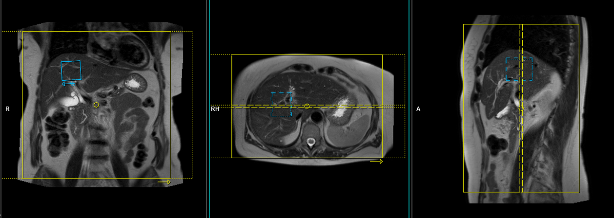 MRCP MRI |MRCP Free Breathing Protocols, Planning, Indications