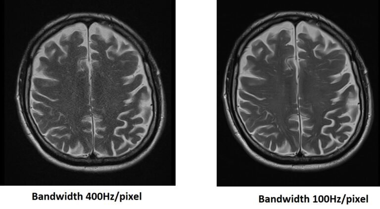MRI Signal-to-noise ratio related artifact | SNR artifacts