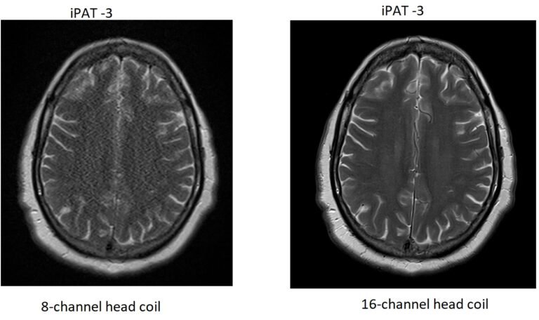 Parallel imaging artifact | MRI Parallel imaging artifact