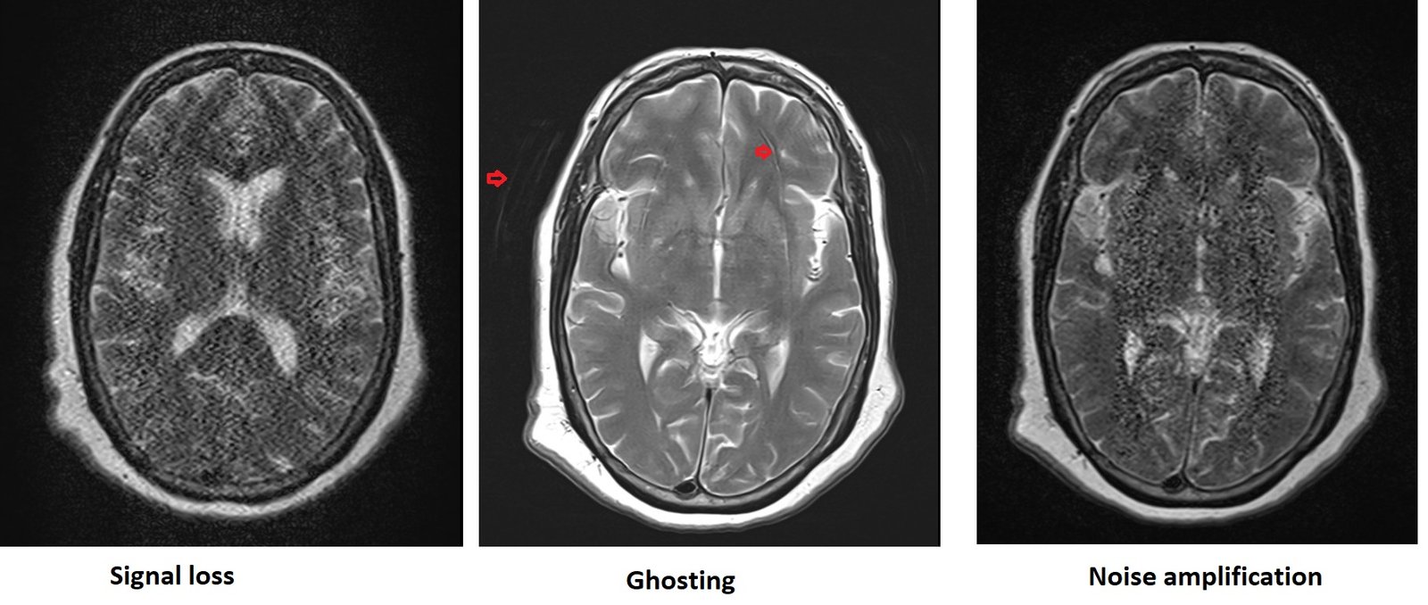 MRI Parallel Imaging Grappa Mri