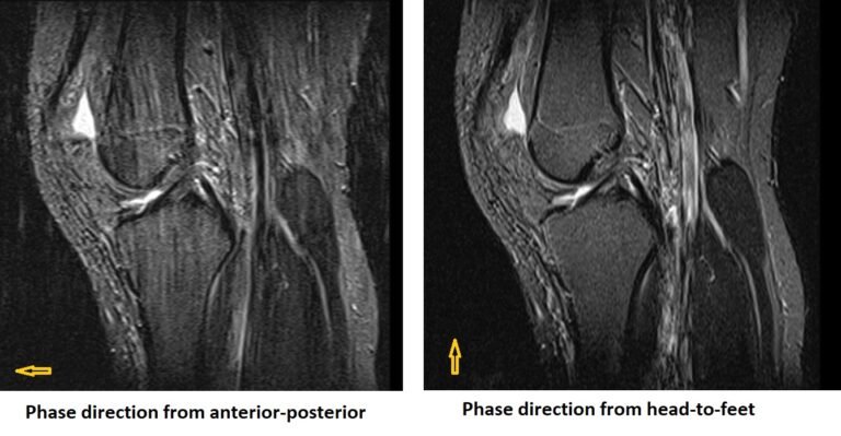 flow artifact mri | csf flow artifact