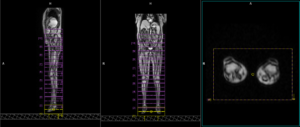 QISS MRA| QISS MRI Protocol and planning