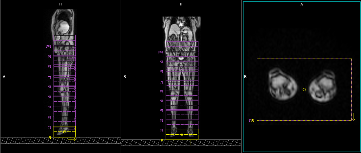 QISS MRA| QISS MRI Protocol and planning