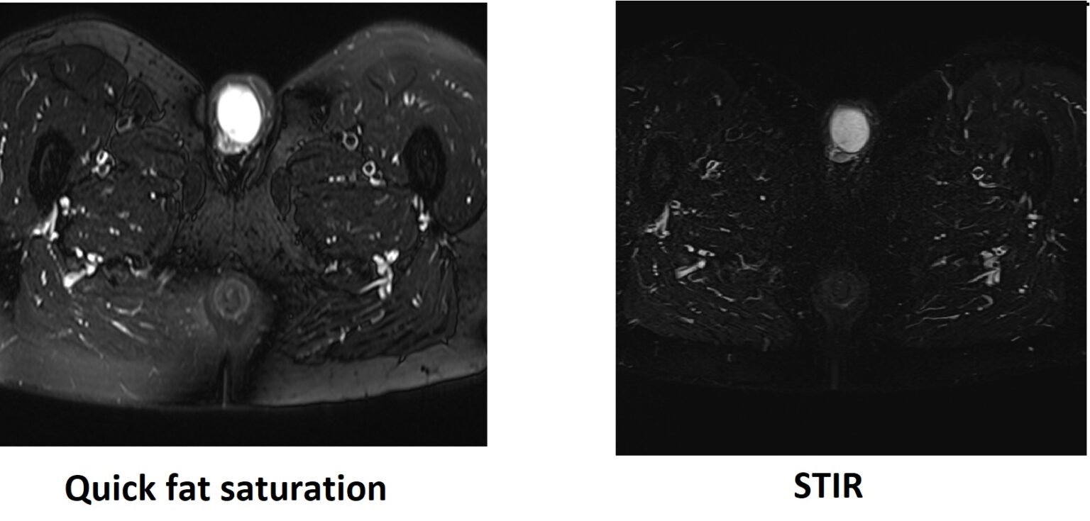 fat suppression artifact MRI | Lipid suppression artifact