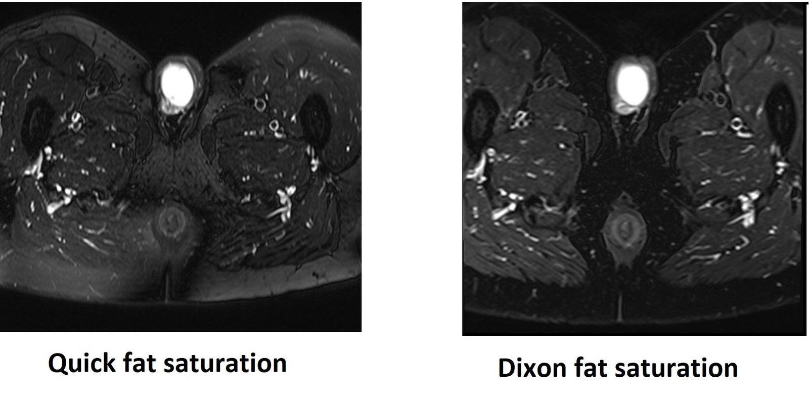 fat suppression artifact MRI | Lipid suppression artifact