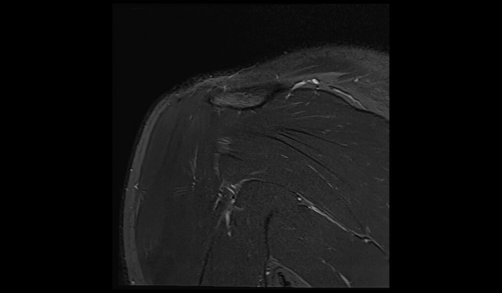PLAN SHOULDER cor stir - mrimaster