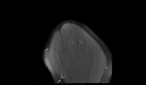 PLAN SHOULDER sag t2 - mrimaster