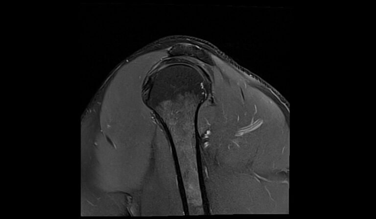 PLAN SHOULDER sag t2 - mrimaster