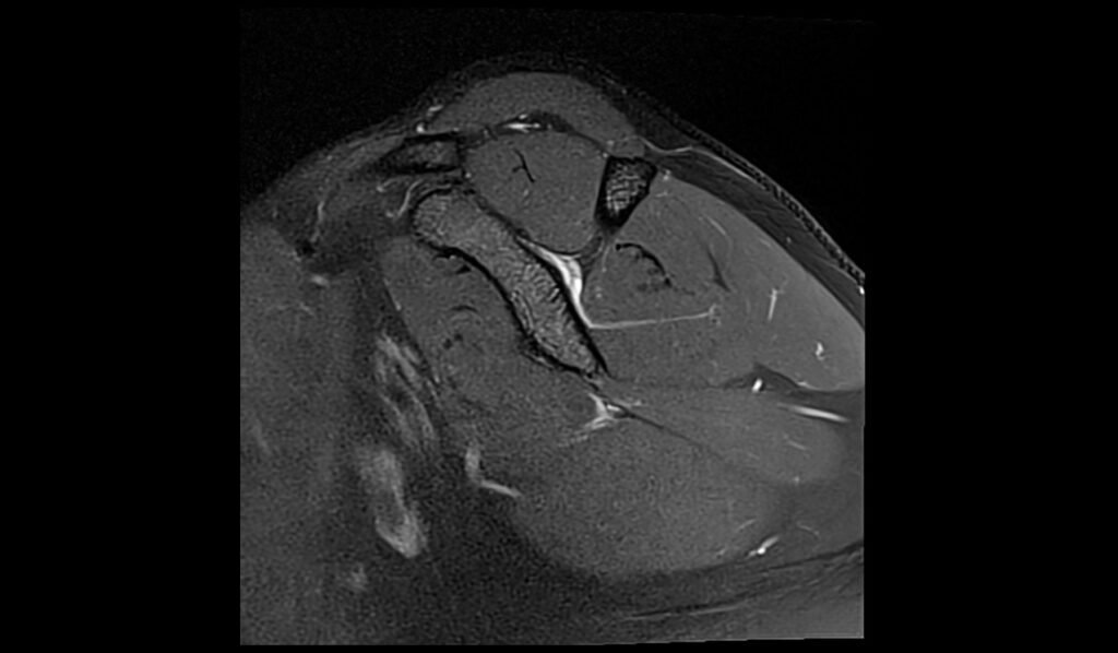 PLAN SHOULDER sag t2 - mrimaster