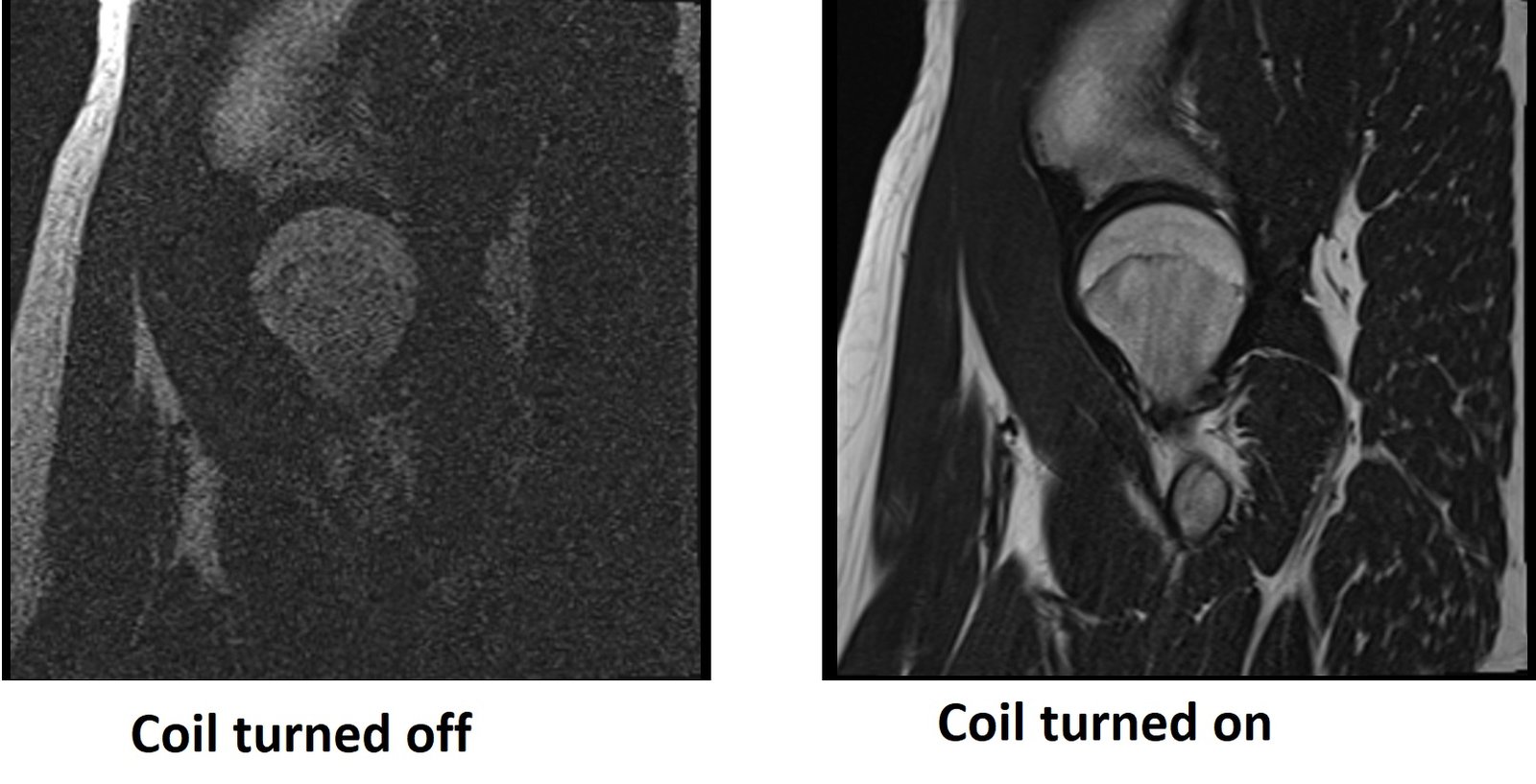 MRI Signal loss artifact