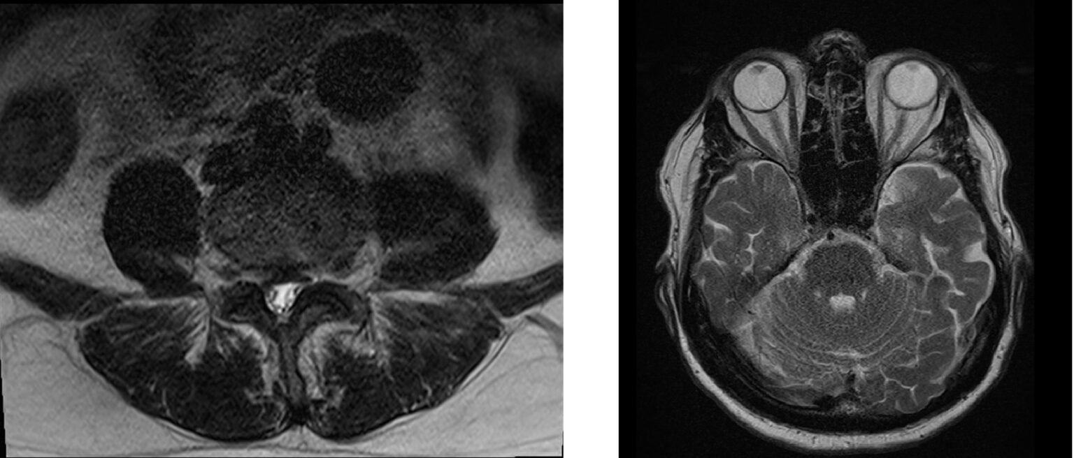 MRI Signal-to-noise ratio related artifact | SNR artifacts