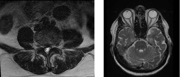 MRI Signal-to-noise ratio related artifact | SNR artifacts