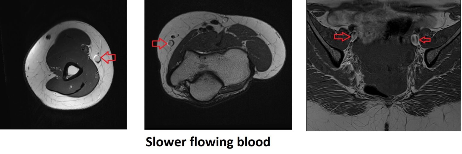 flow artifact mri | csf flow artifact