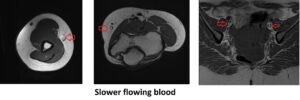 flow artifact mri | csf flow artifact
