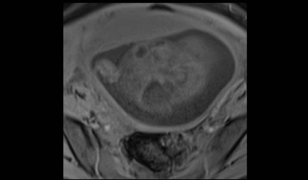 fetal brain mri axial t1 images